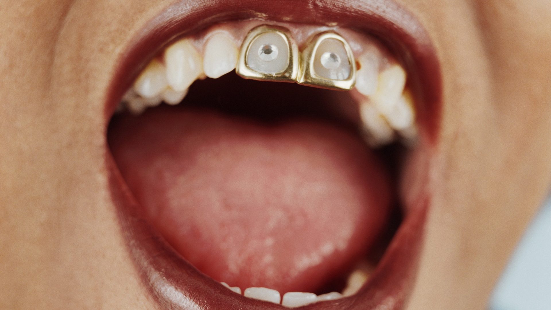 Permanente Gouden Tanden Verwijderen Tooth Gem: Lees Hier Alles Wat Je